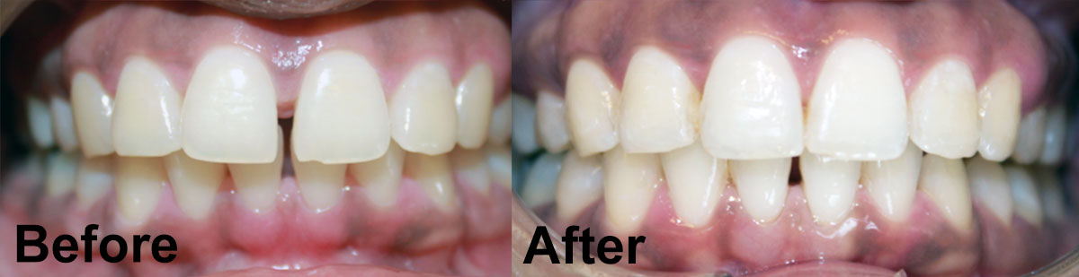 Straight Teeth Invisible Braces in Bedfordshire